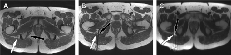 음부신경차단술(Pudendal Nerve Block) : Stop and Go technique [네오유여성비뇨기과] : 네이버 블로그