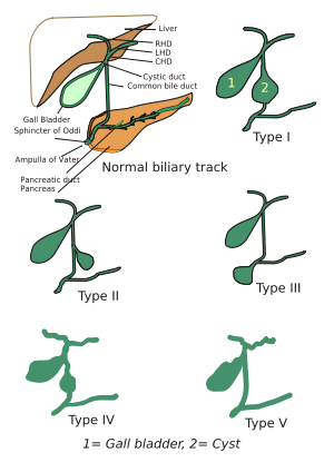 [1부] 소아의 담도 및 담낭질환/ 총담관낭 (Choledochal cyst)/ 간내 담관의 낭성 확장 (Caroli 병 ...