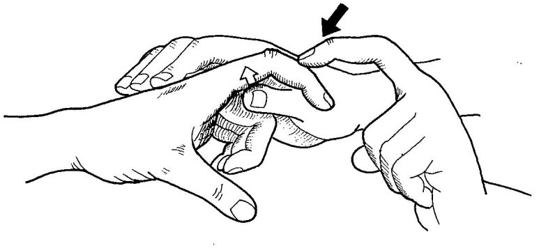 [Wrist and hand Special Test] Bunnel-Littler test : 네이버 블로그