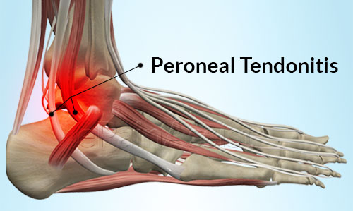 비골건염(Peroneal tendonitis) - [부산 화명동PT, 화명PT, 화명동 개인트레이닝, 화명동 다이어트, 화명동 ...