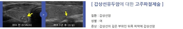 갑상선유두암에 대한 고주파절제술 석회가 동반되어 있어 치료 후 암의 위치확인 용이 갑상선 깊은 부위인 뒤쪽 피막에 갑상선암