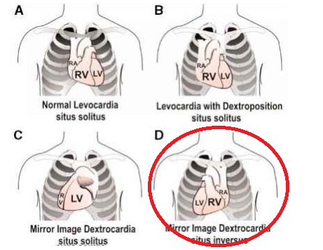 전내장역위증 (situs inversus totalis) 심초음파 평가 : 네이버 블로그