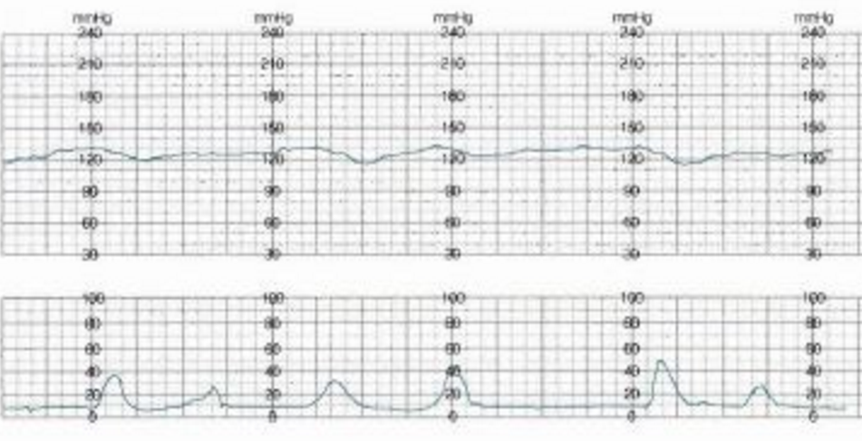 Late deceleration(만기하강, 지연성 일과성서맥) 그래프 해석 및 처치과정 : 네이버 블로그