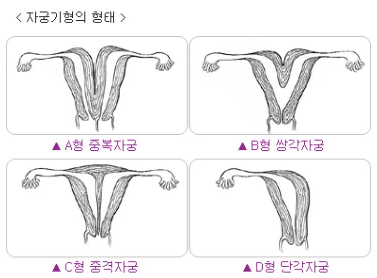 3쌍각자궁 임신자궁 기형 종류 네이버 블로그