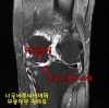 근위경골절골술 연골판파열 미세천공술 연골재생과 휜다리 교정하는 제이본정형외과 권제호 네이버 블로그