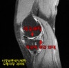 근위경골절골술 연골판파열 미세천공술 연골재생과 휜다리 교정하는 제이본정형외과 권제호 네이버 블로그