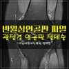 연골판 파열 무릎 관절경 반월상 연골판 절제 방법 제이본정형외과 권제호 네이버 블로그