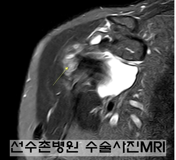견갑하근 회전근개파열 봉합술앞쪽위쪽 어깨통증 네이버 블로그
