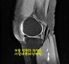 연골판 파열 무릎 관절경 반월상 연골판 절제 방법 제이본정형외과 권제호 네이버 블로그