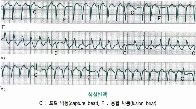 capture beat(포획박동)과 fusion beat(융합박동) : 네이버 블로그
