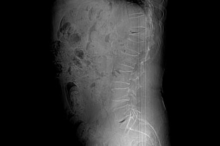 척추체의 무혈성 괴사(Kummel disease) : 척추에 공기가 보여요 : 네이버 블로그