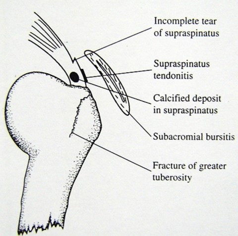 통증 호 징후(Painful arc sign) : 극상근건, 극하근건의 이상을 조사하는 검사 : 네이버 블로그