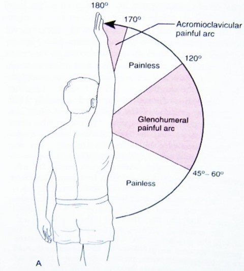 통증 호 징후(Painful arc sign) : 극상근건, 극하근건의 이상을 조사하는 검사 : 네이버 블로그