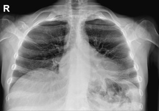 Chest apicography : 네이버 블로그