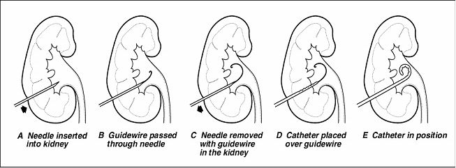 임상) 배액관 ① - PCN (경피적 신루설치술) 목적, 방법, 간호 : 네이버 블로그