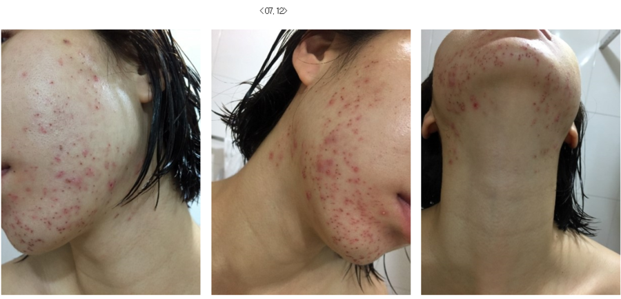 아그네스레이저 후기 및 부작용피부과 여드름 치료 네이버 블로그