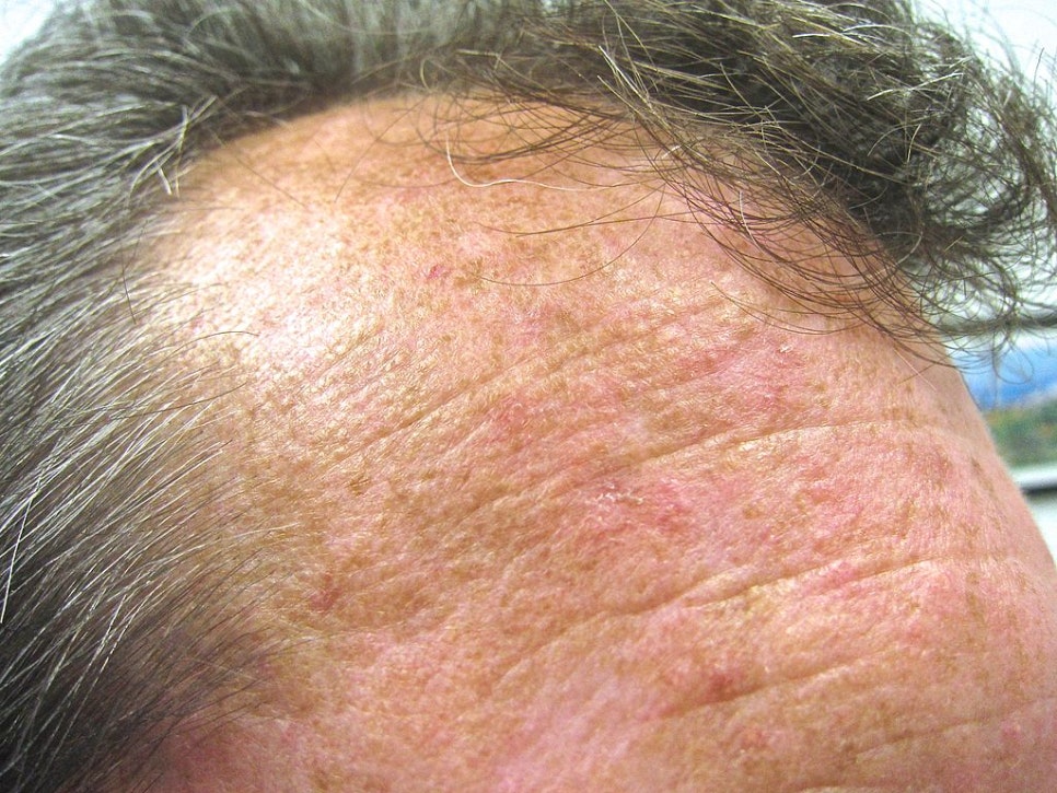 Actinic keratosis : 네이버 블로그