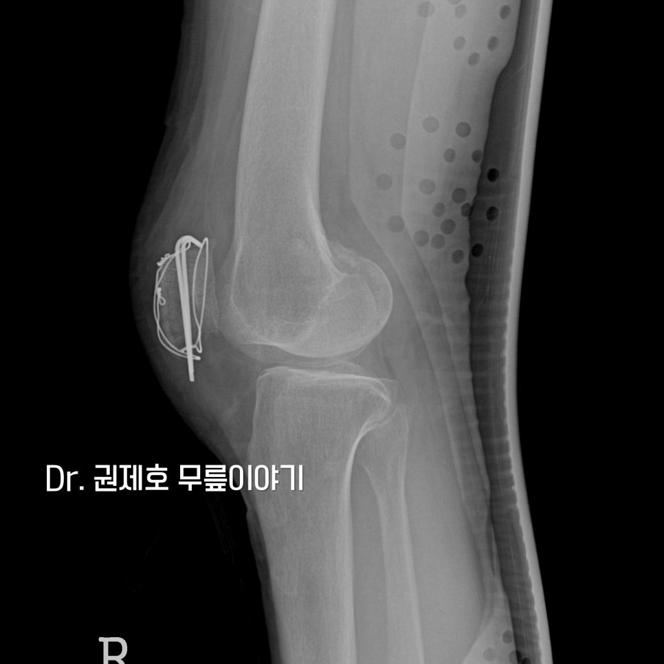 무릎슬개골골절 와이어를 이용한 Figure 8자 고정술 네이버 블로그