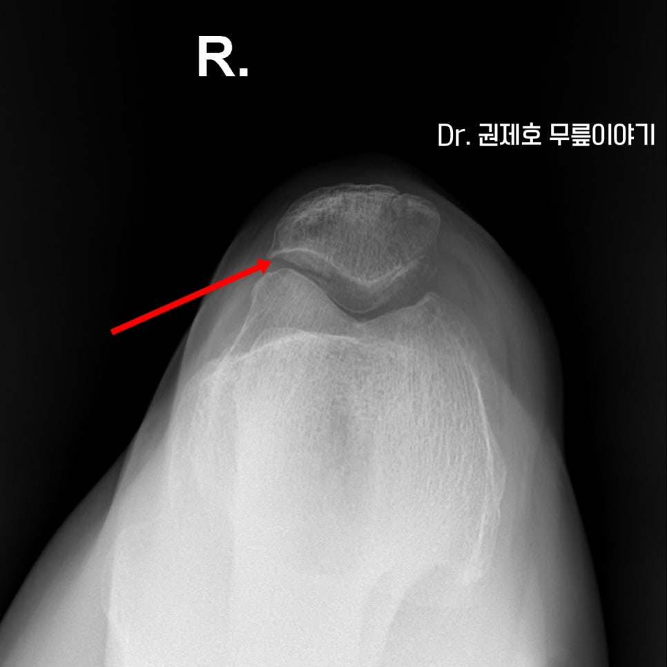 무릎슬개골골절 와이어를 이용한 Figure 8자 고정술 네이버 블로그