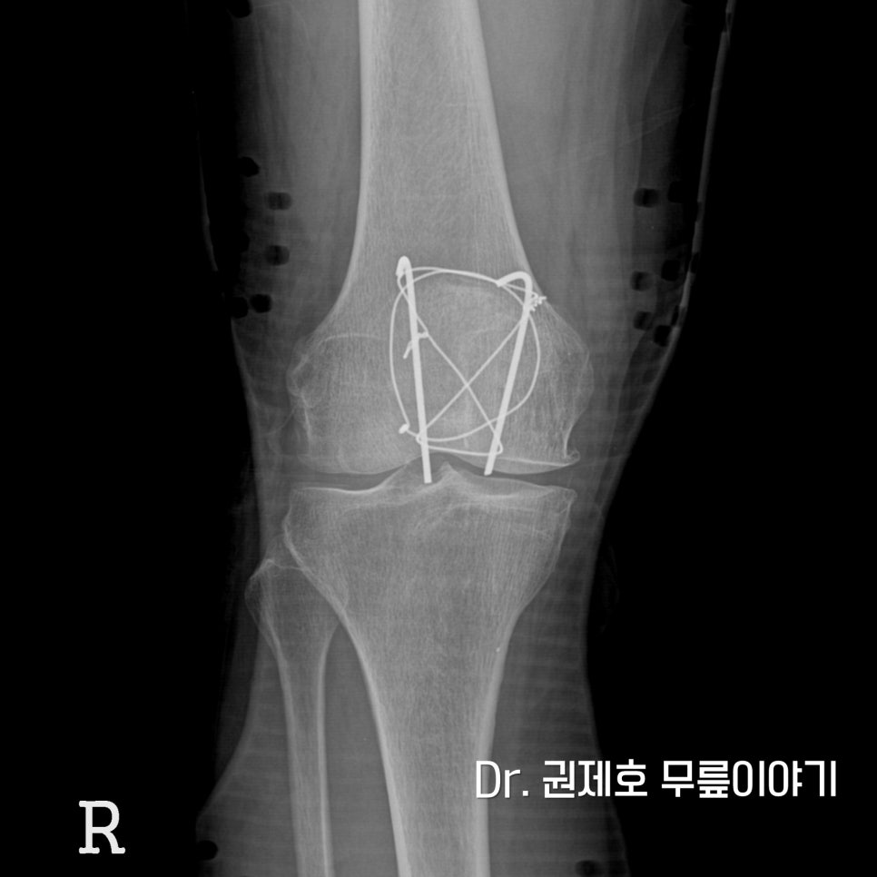 무릎슬개골골절 와이어를 이용한 Figure 8자 고정술 네이버 블로그