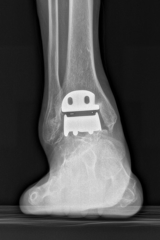 TAR (Total Ankle Replacement) : 네이버 블로그