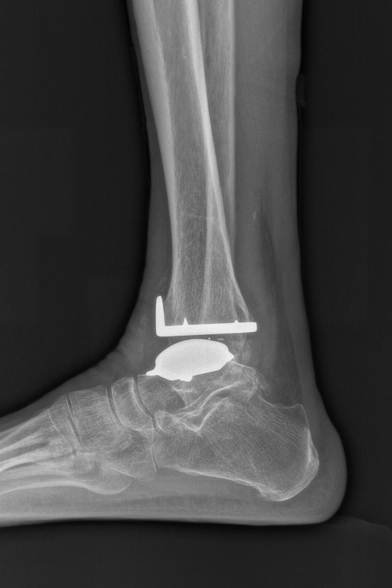 TAR (Total Ankle Replacement) : 네이버 블로그