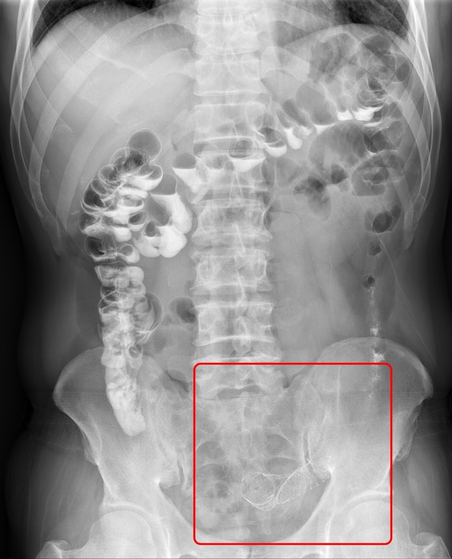 colon stent : 네이버 블로그