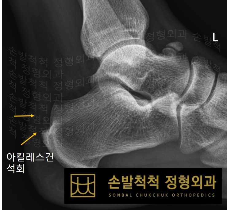 풍무동손발척척정형외과 아킬레스건염 석회성힘줄염 도수치료 체외충격파 보톡스 네이버 블로그