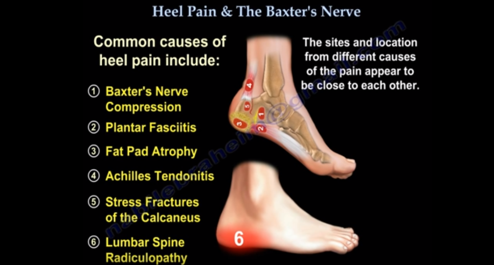Heel Pain & The Baxter's Nerve 뒤꿈치 통증(발바닥 통증) 과 박스터신경 : 네이버 블로그