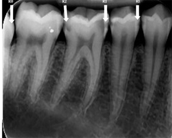 치과에서 촬영하는 엑스레이 ( x-ray ) 종류 :: 치과 방사선 사진 :: 파노라마 / CBCT 등 by 닥터자일리톨 ...