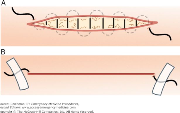 신장이식수술 시 피부 봉합의 방법(Subcuticular suture) "저는 실밥이 없어요!" : 네이버 블로그