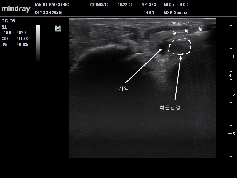 팔꿈치터널 증후군 척골신경마비 새끼손가락 저림 네이버 블로그