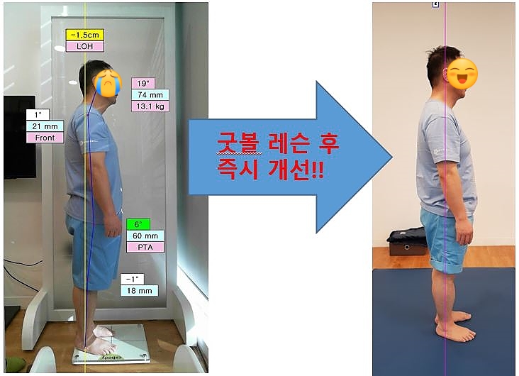 거북목 일자목굽은등으로 인한 어깨통증 뒷목통증 안구건조로 우울했던 중년의 직장인 남성 굿볼이 함박웃음을 되찾아 주었다