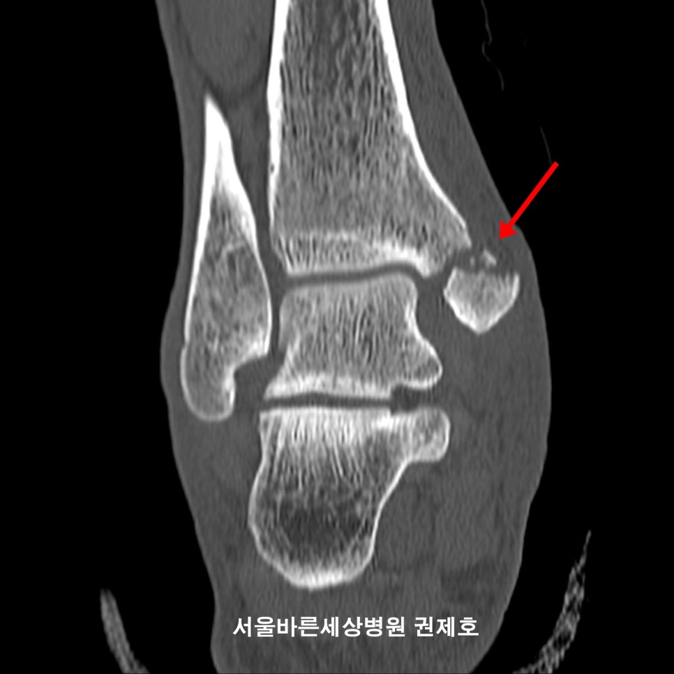 복사뼈골절 발목접질렀을때 걷지 못할 정도라면 네이버 블로그