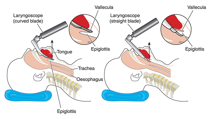 Intubation(기관내삽관), Endotracheal tube(E-tube 간호, 고정, 적응증, 물품, 절차) : 네이버 블로그