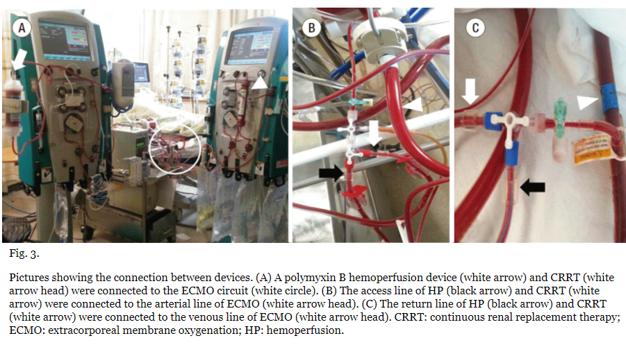 ECMO(에크모) 치료,간호 및 환자관리. Extracorporeal Membrane Oxygenation(VA,VV type) : 네이버 블로그