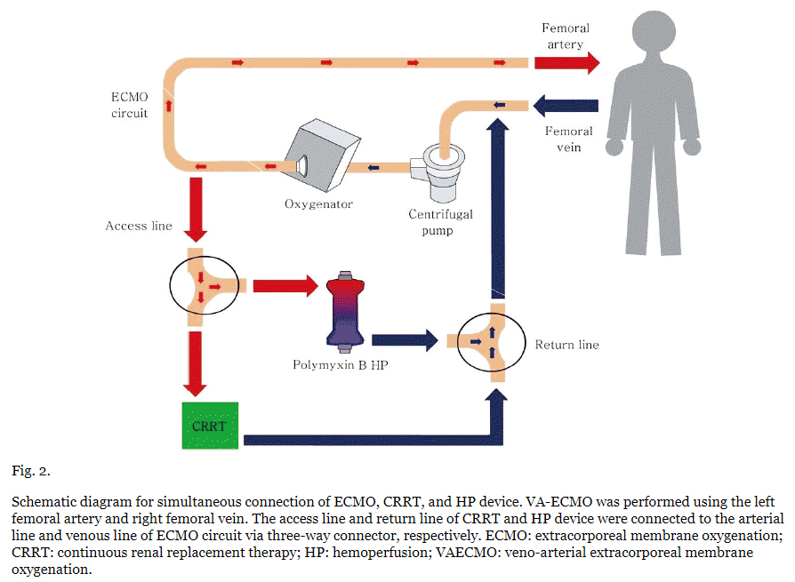 ECMO(에크모) 치료,간호 및 환자관리. Extracorporeal Membrane Oxygenation(VA,VV type) : 네이버 블로그