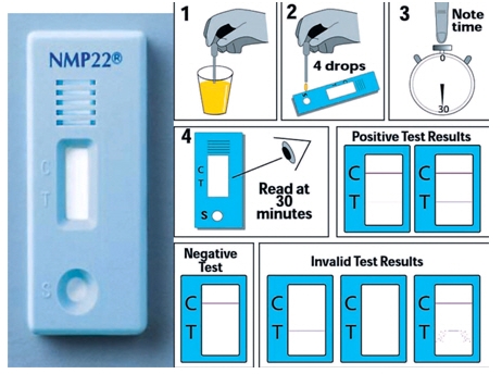 방광암 진단 Marker-NMP22 BladderChek Test : 네이버 블로그