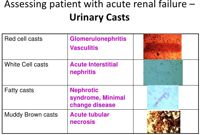 acute tubular necrosis : 네이버 블로그