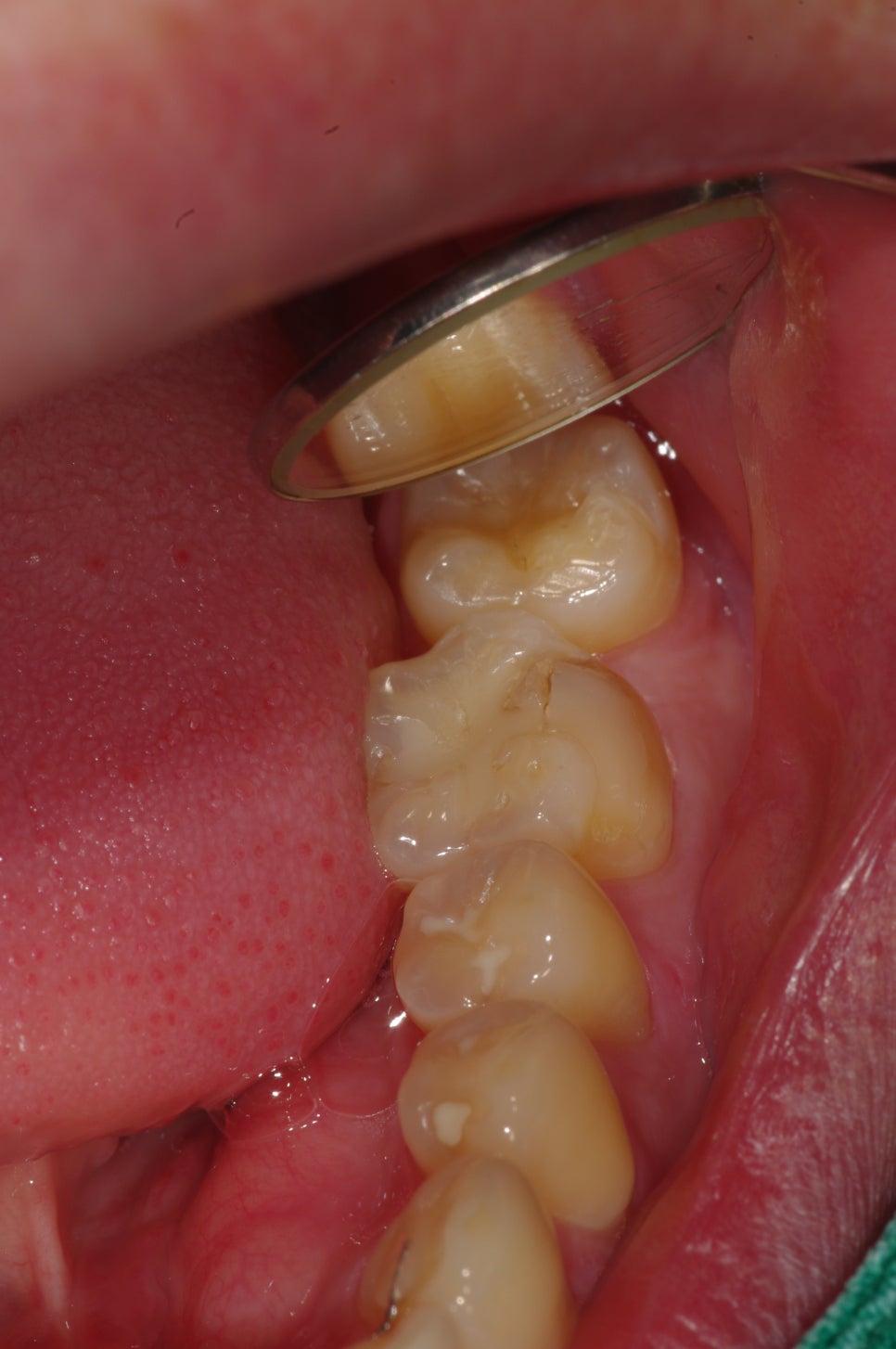 은평구 치과 , 서울덴치과이야기 : 네이버 블로그