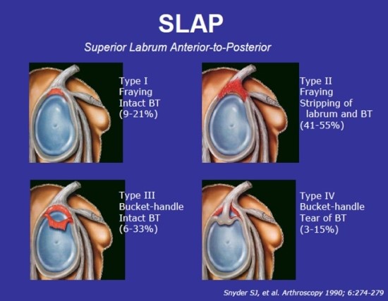 슬랩(상부 관절와순 병변, SLAP) 수술은 하지 않는 것이 좋다 : 네이버 블로그
