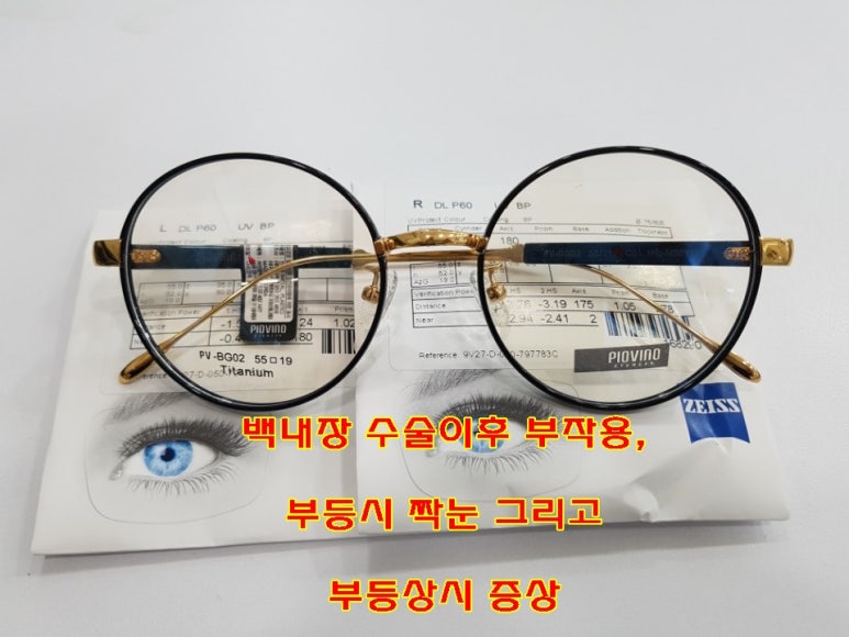단안 백내장 수술이후 나타난 부작용 부등시 짝눈 그리고 부등상시증상 백내장 수술 부작용의 최소화 부산 부등시 짝눈 해결