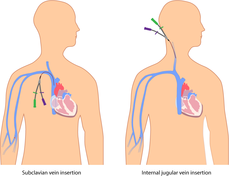 중심정맥관(Central Venous Catheter), PICC에 대해서. [종류, 합병증, 관리, 삽입] : 네이버 블로그