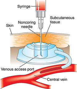중심정맥관(Central Venous Catheter), PICC에 대해서. [종류, 합병증, 관리, 삽입] : 네이버 블로그
