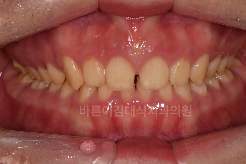 부산 보철치료 법랑질형성부전 전악보철crown 사례입니다 네이버 블로그