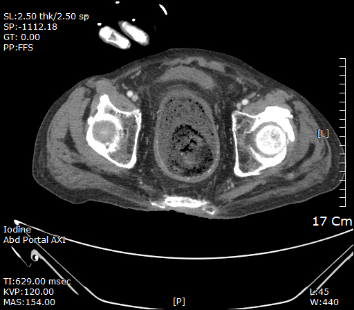 Stercoral colitis - 대변이 colon을 막으면 위험해! : 네이버 블로그
