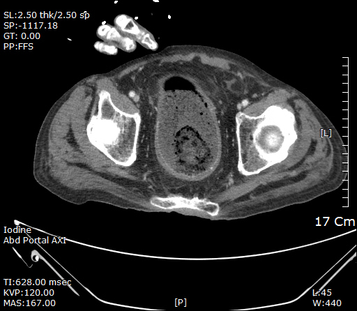 Stercoral colitis - 대변이 colon을 막으면 위험해! : 네이버 블로그