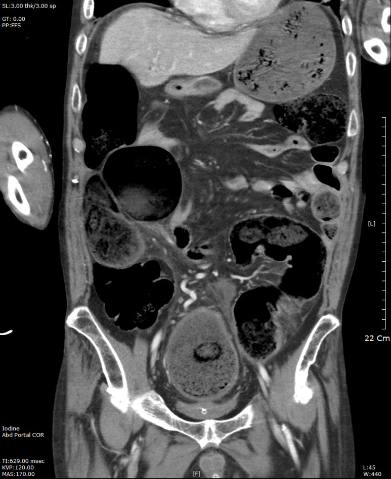 Stercoral colitis - 대변이 colon을 막으면 위험해! : 네이버 블로그