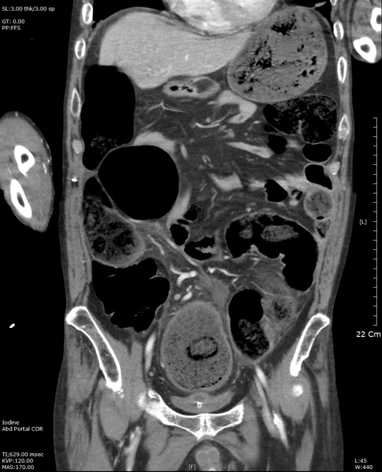 Stercoral colitis - 대변이 colon을 막으면 위험해! : 네이버 블로그