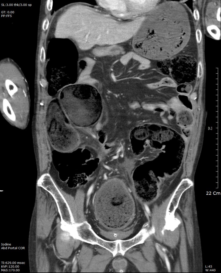 Stercoral colitis - 대변이 colon을 막으면 위험해! : 네이버 블로그